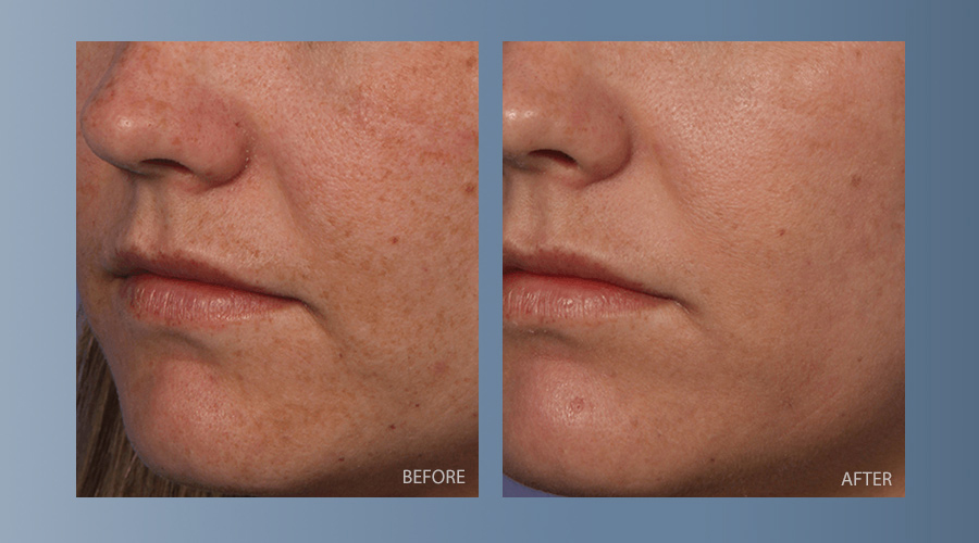 No Time to Lose, Fall is the Best Time to Fraxel! - DermPhysicians of ...